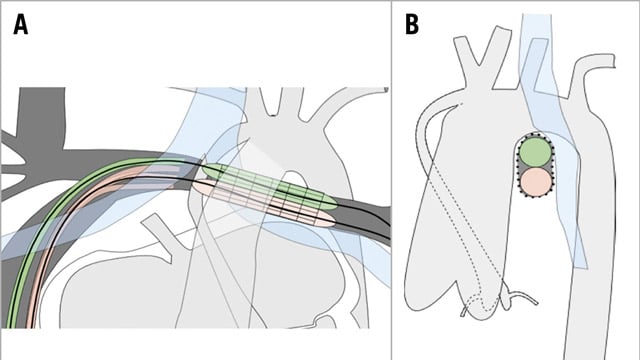 Oval stenting in left pulmonary artery stenosis: a novel double balloon ...