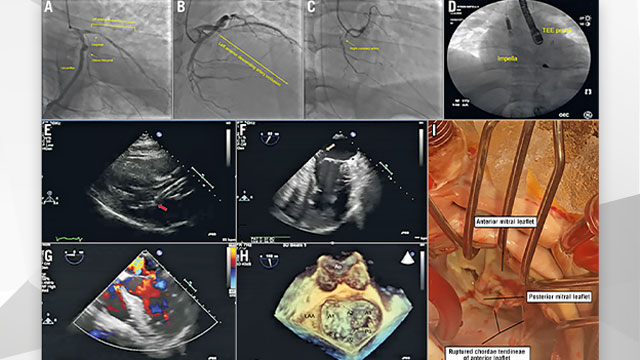 Entrapment of the Impella heart pump in the mitral subvalvular apparatus