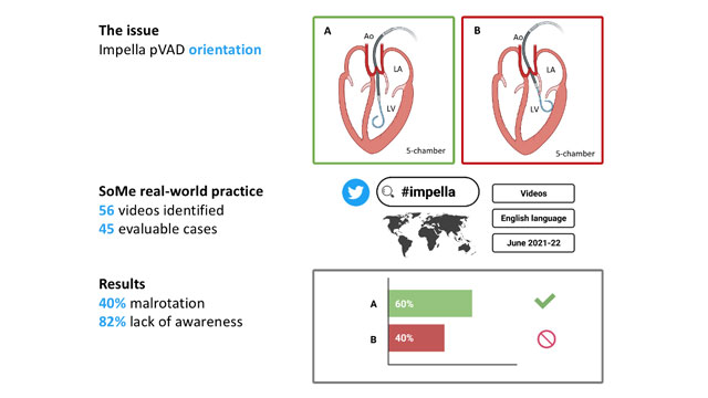 Impella percutaneous ventricular assist device malrotation in social ...