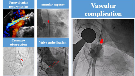 TAVI (Transcatheter aortic valve implantation)