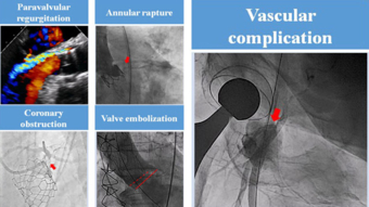 TAVI (Transcatheter aortic valve implantation)