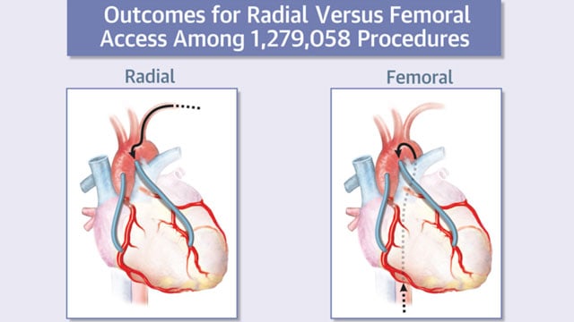 Characteristics and outcomes of patients with history of CABG ...