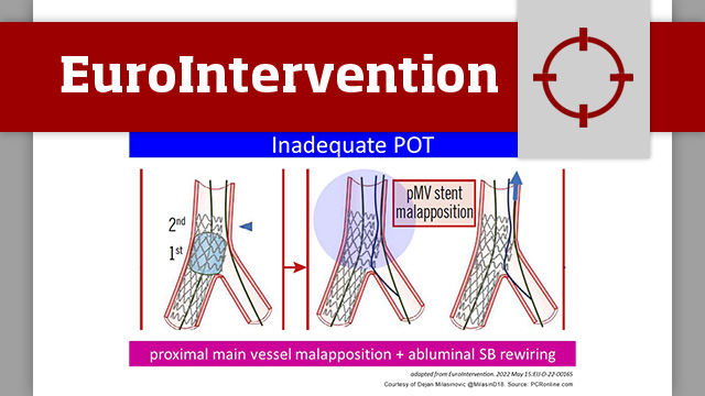 Treatment of coronary bifurcation lesions, part I: implanting the first ...