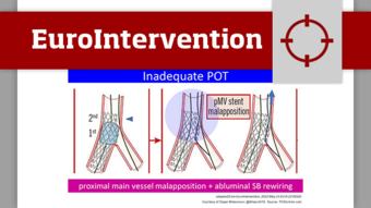 Bifurcation lesions