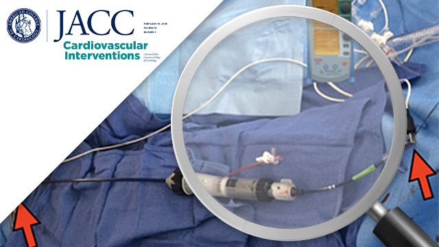 Left Ventricular Rapid Pacing Via the Valve Delivery Guidewire in ...