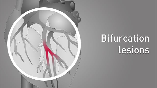 Bifurcation lesions