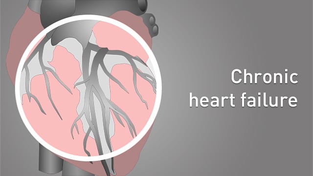 Chronic heart failure