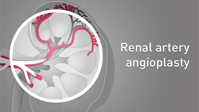 Renal artery angioplasty