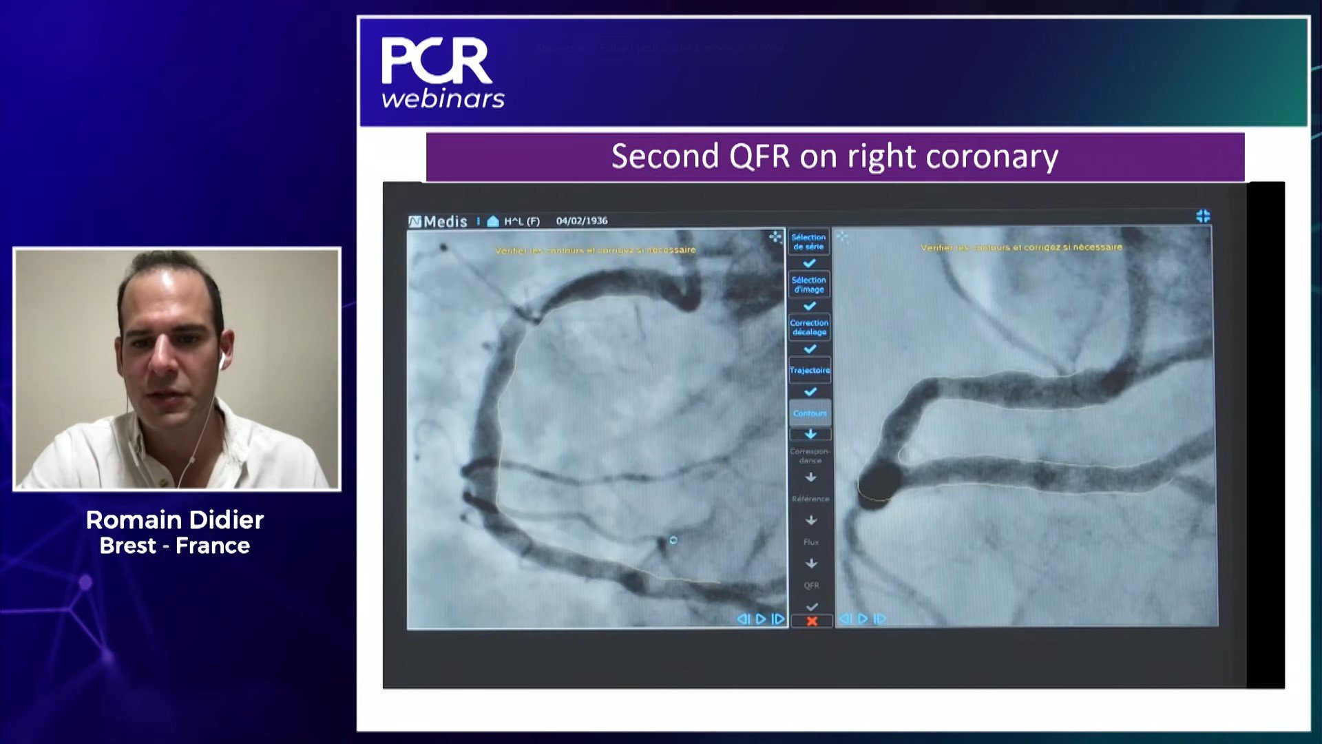 How the QFR in your cathlab can help us to assess non-invasively the ...