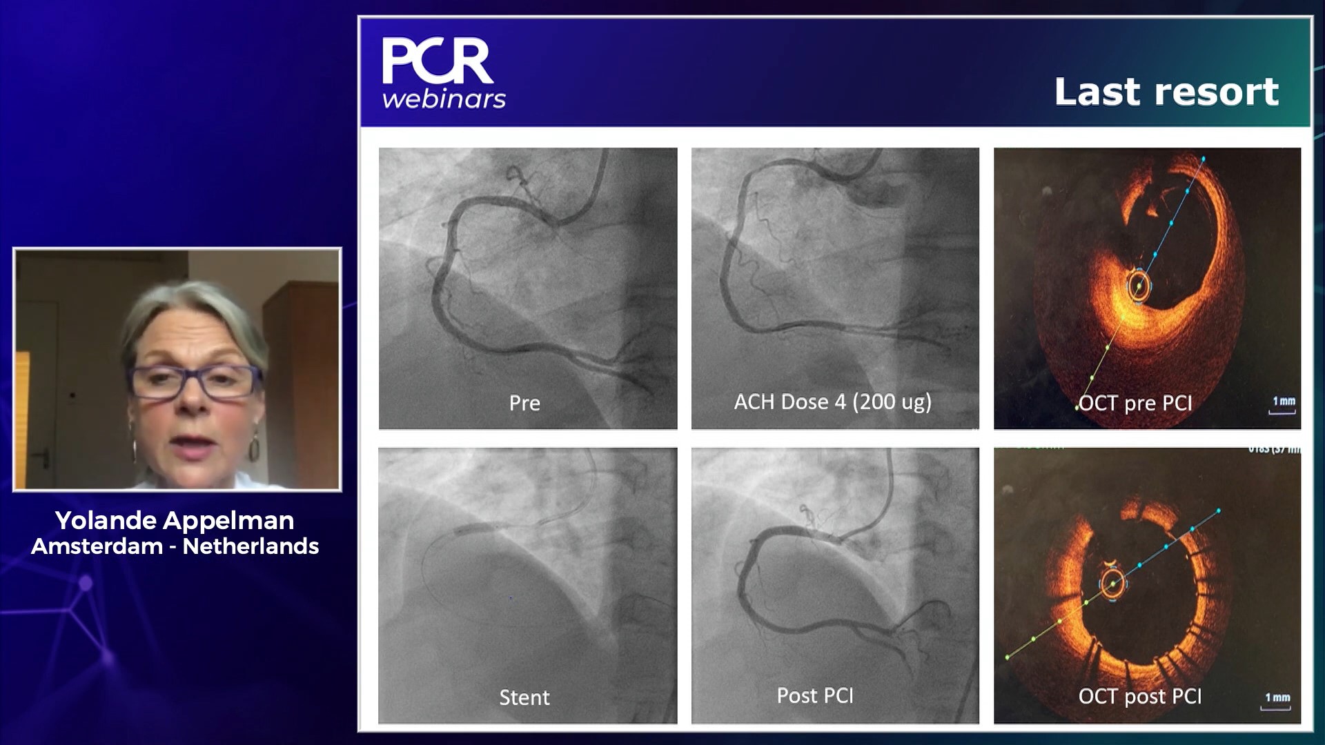 Stratified treatment of INOCA: from the cathlab to the outpatient clinic