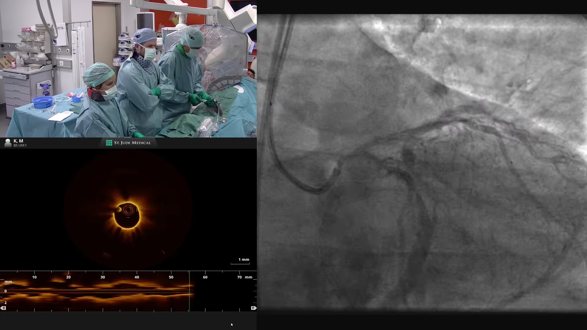 Left main bifurcation PCI – proper use of imaging guidance