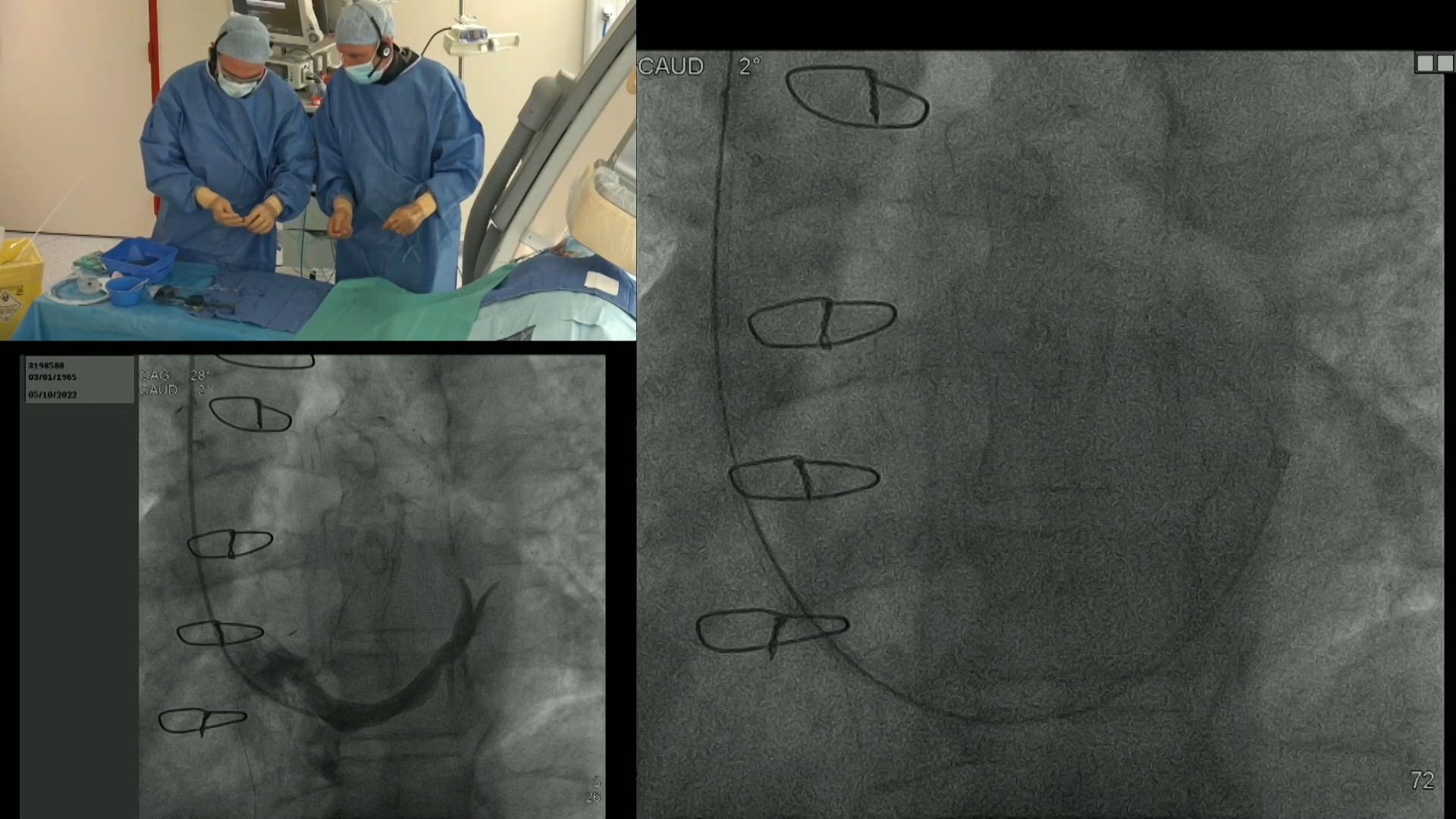 How should I treat a patient with refractory angina using the Reducer ...