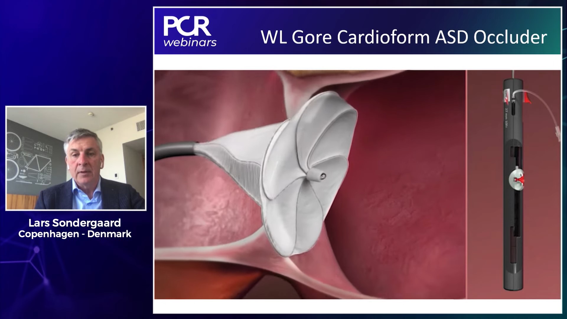 Device closure Of Challenging Atrial Septal Defects Device closure Of Challenging Atrial Septal Defects