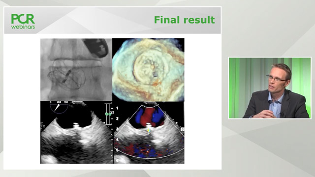 PFO closure in 2019 – Who, Why and How?