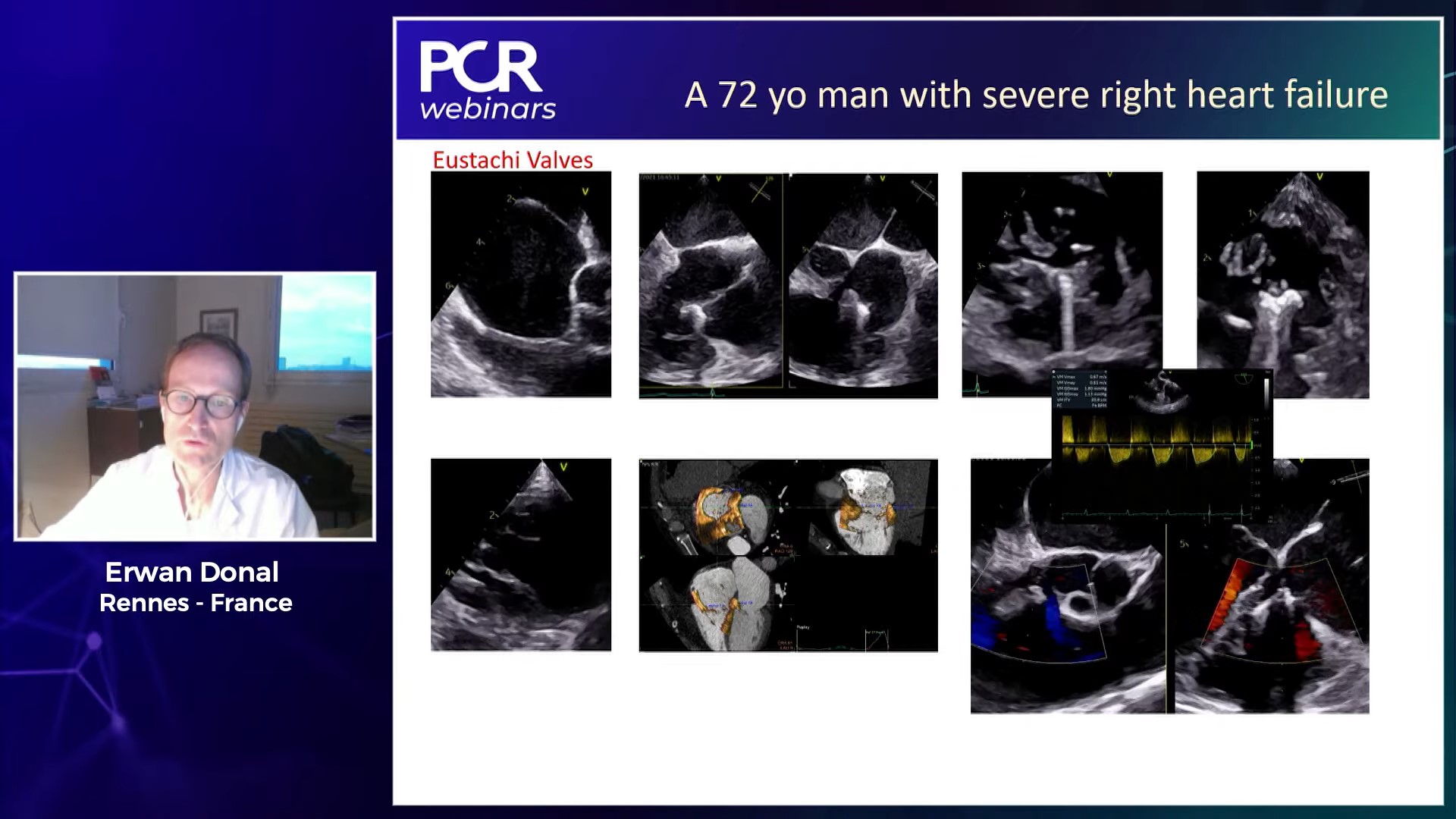 Imaging the journey of a patient with severe tricuspid regurgitation ...