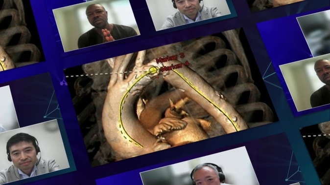 TAVI (Transcatheter aortic valve implantation)