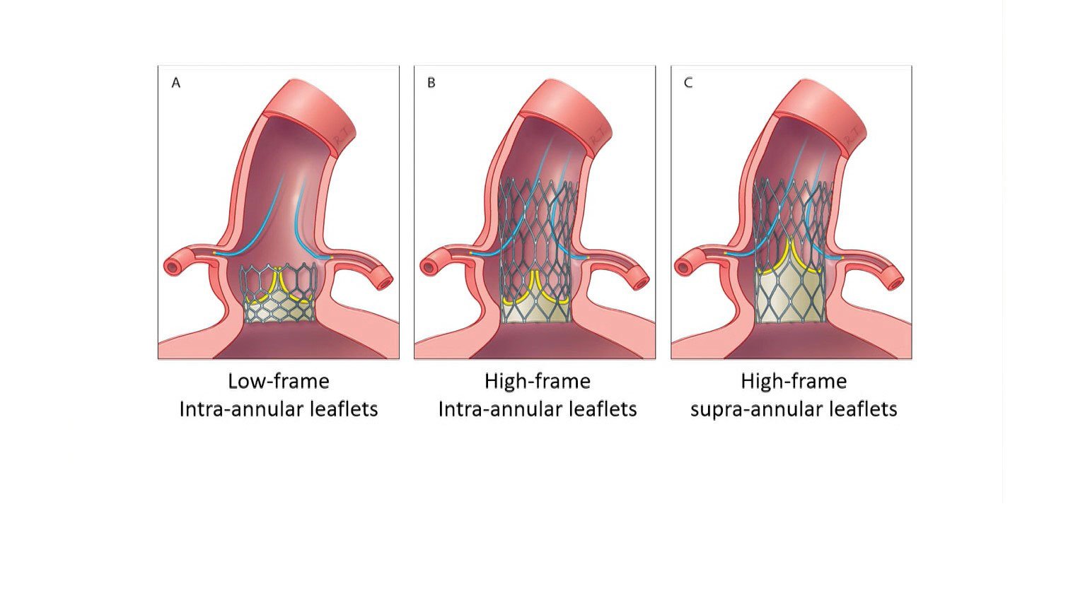 TAVI and Coronary access