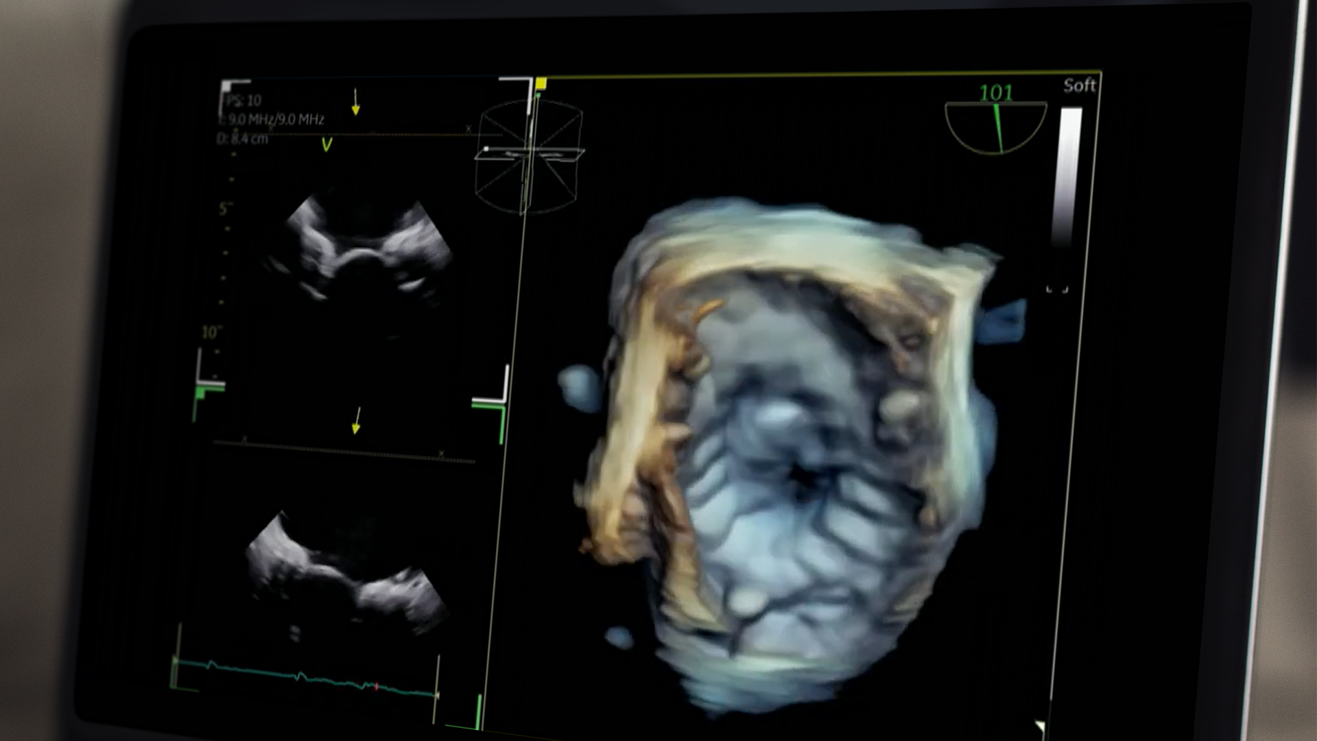 Intracardiac echocardiography for tricuspid interventions